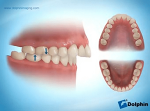 Common Bite Problems | Tōtara Orthodontists in New Lynn, Auckland