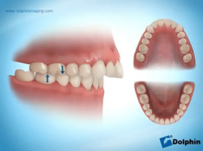 Common Bite Problems | Tōtara Orthodontists in New Lynn, Auckland